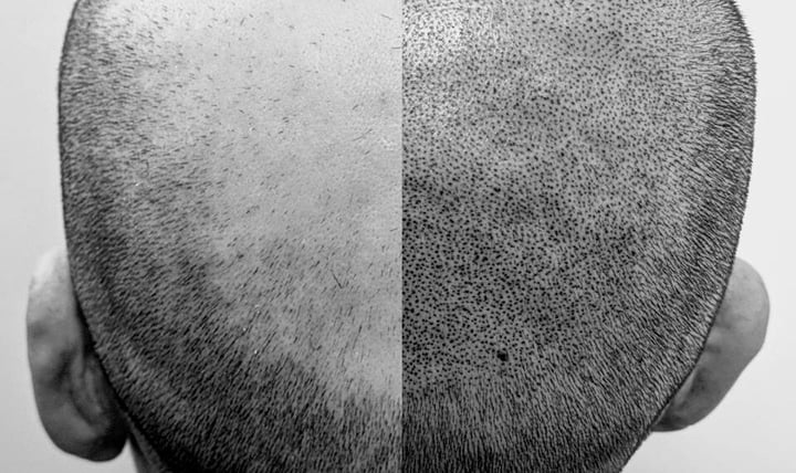 Hair Loss Solution | Scalp Micropigmentation by Good Look Ink