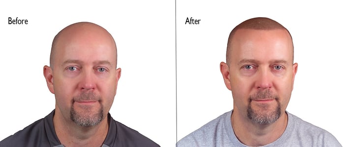 Scalp Micropigmentation | SMP Hair Good Look Ink