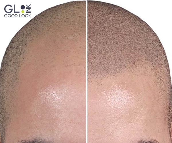 Scalp Micropigmentation | SMP Hair Good Look Ink