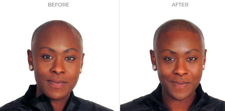 Scalp Micropigmentation | SMP Hair Good Look Ink