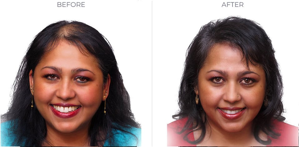 Scalp Micropigmentation | SMP Hair Good Look Ink